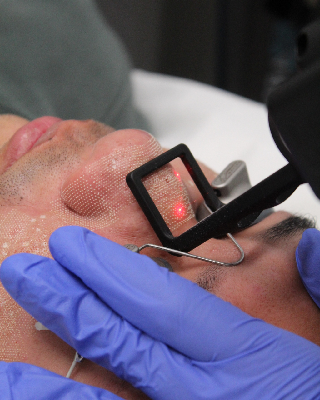 Hyperhidrosis (Excessive Sweating) – Southern Dermatology