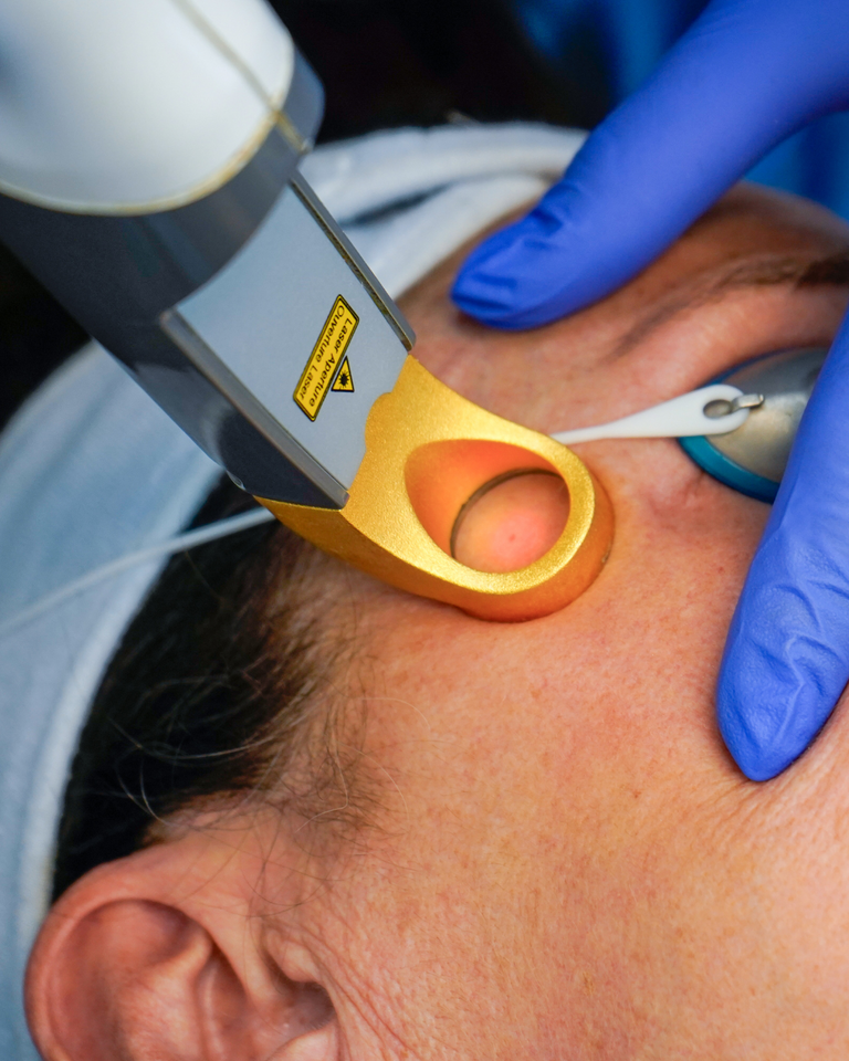 CoolView Laser for Redness, Veins, and Capillaries – Southern Dermatology