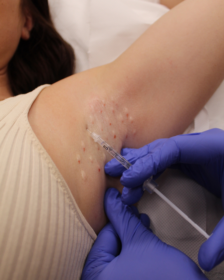 Hyperhidrosis (Excessive Sweating) – Southern Dermatology