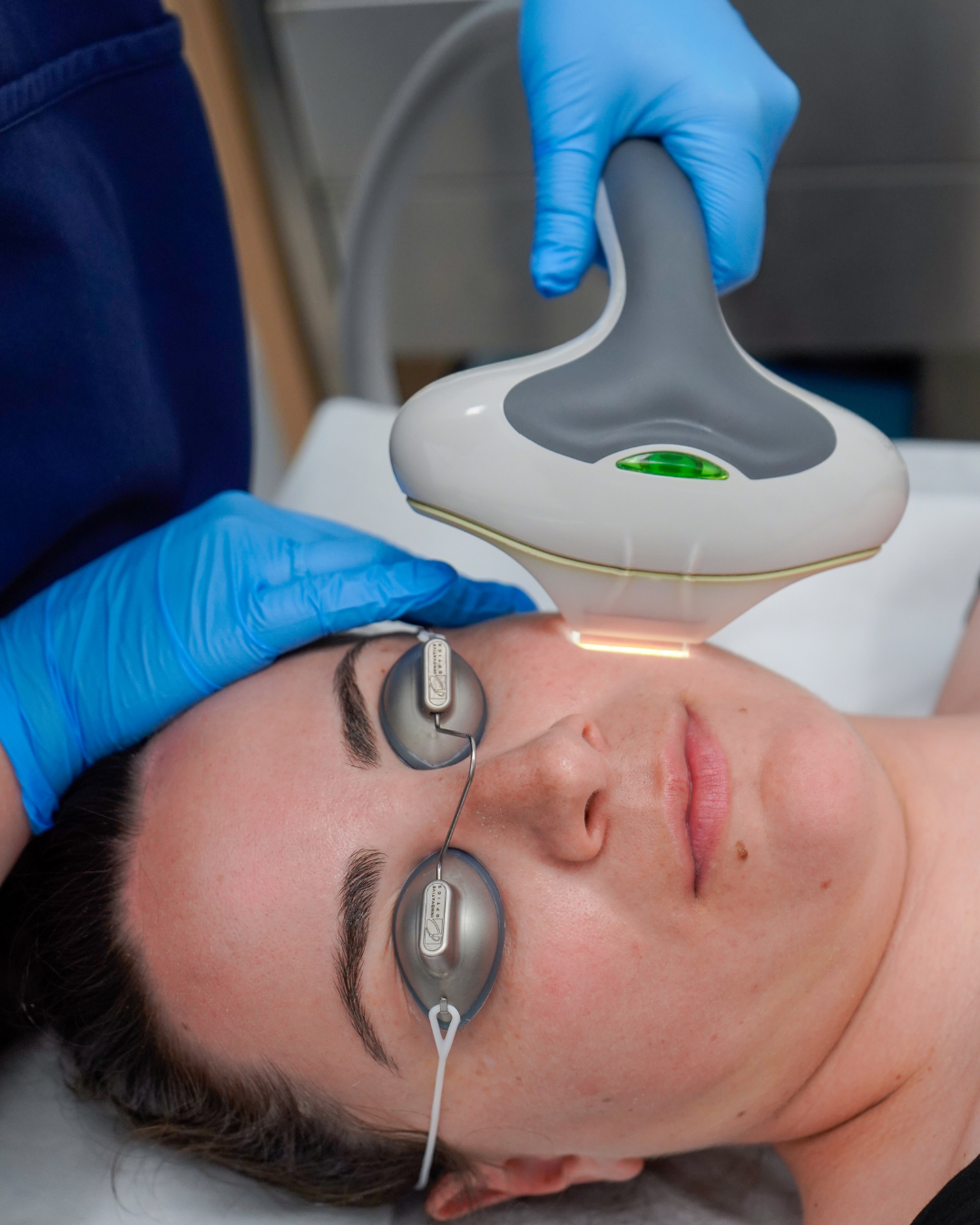 Laser Skin Rejuvenation with XEO IPL – Southern Dermatology