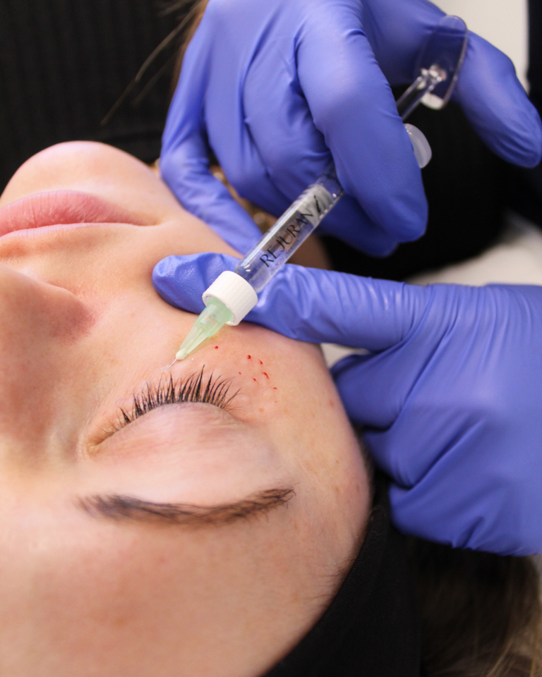 Hyperhidrosis (Excessive Sweating) – Southern Dermatology