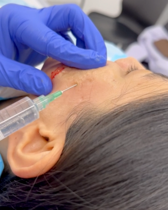 Subcision – Southern Dermatology